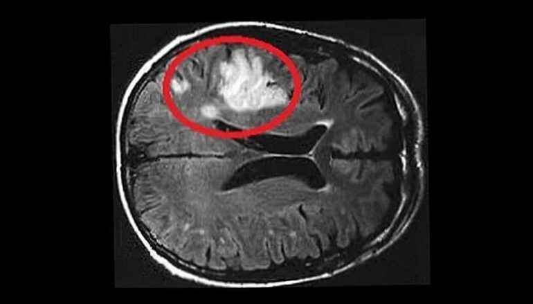 Schlaganfall: Prävention & Therapie | Neurologe Wien